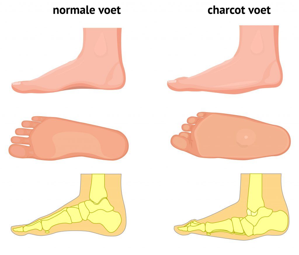 Charcot voet - Oorzaken, Symptomen, Behandeling | Livit Ottobock
