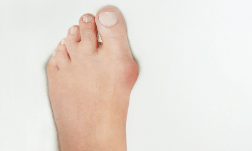 Hallux Valgus- Oorzaken, Symptomen, Behandeling | Livit Ottobock