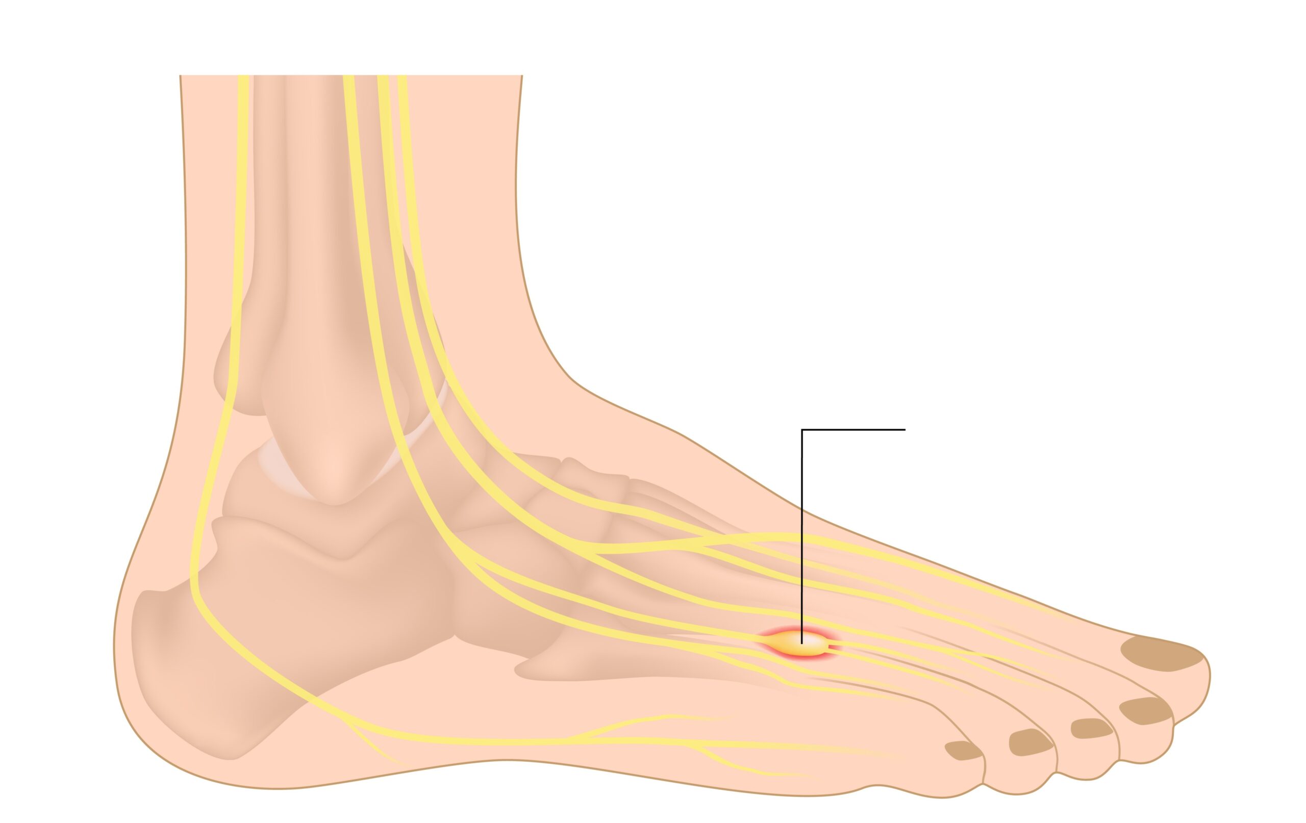 Morton neuroom - Oorzaken, Symptomen, Behandeling | Livit Ottobock